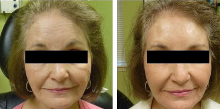 Botox/Dysport • Babcock Dermatology